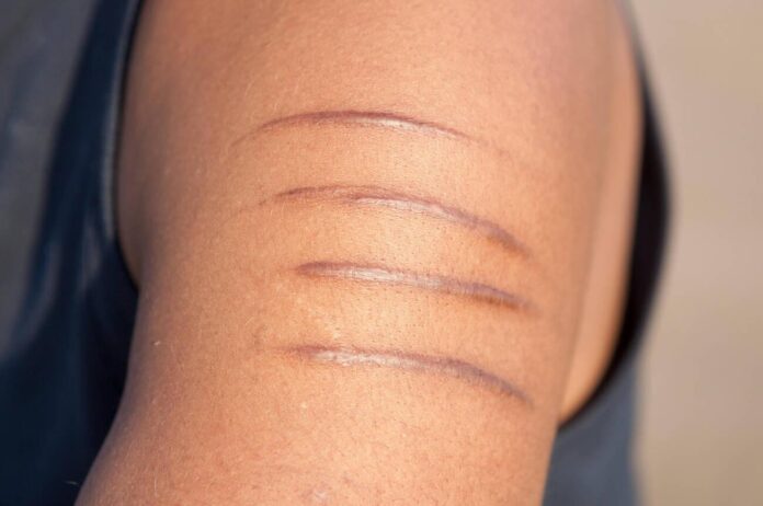 10 Best Scar Cover Up Tattoos with Aftercare Tips