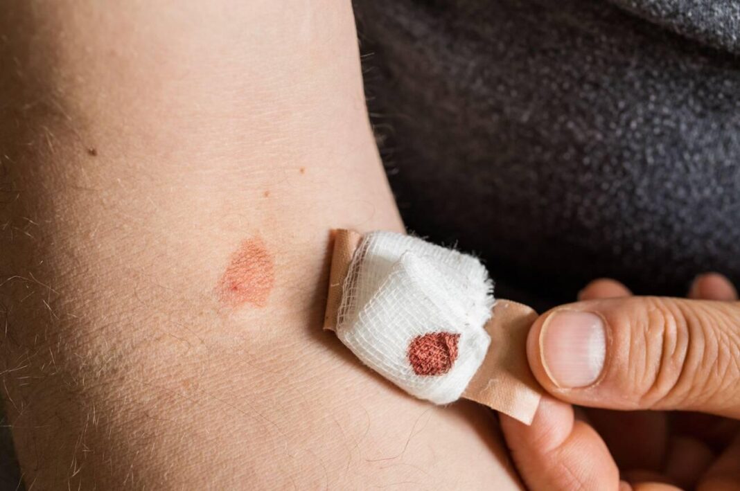 Uncovering the Mystery of Rash that Looks Like Hickey | Editorialge