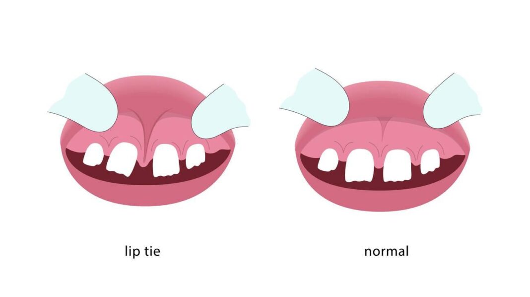 Lip Tie Surgery: A Complete Guide to Treatment and Recovery