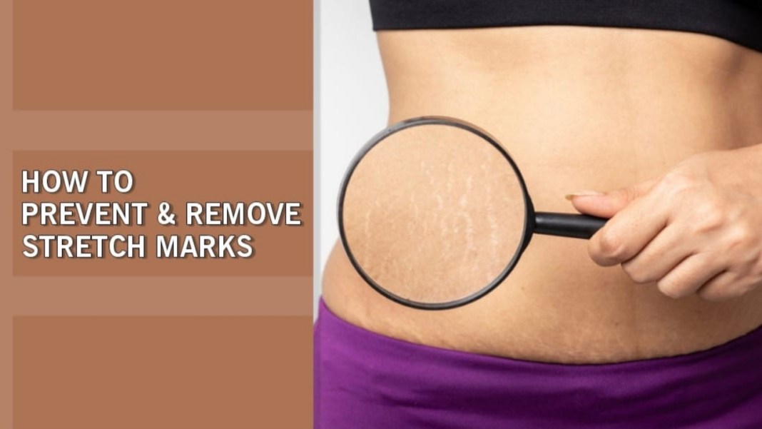 10 Tips on How to Prevent and Remove Stretch Marks on the Body