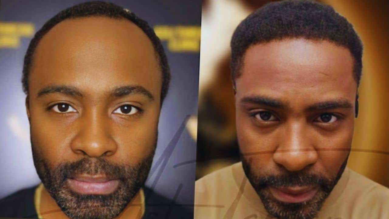 Hyperpigmentation Meme: The Viral Trend Everyone's Talking About